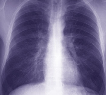La bronchite aiguë : virale ou bactérienne? - Maison et Santé