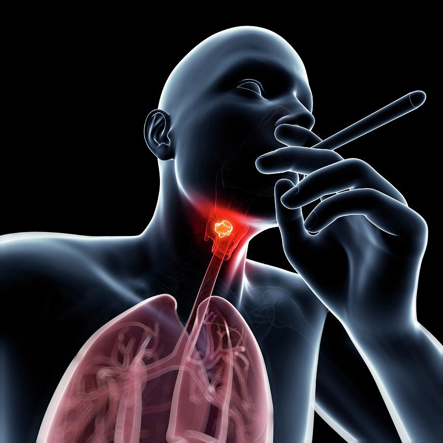 Le cancer du larynx - Maison et Santé