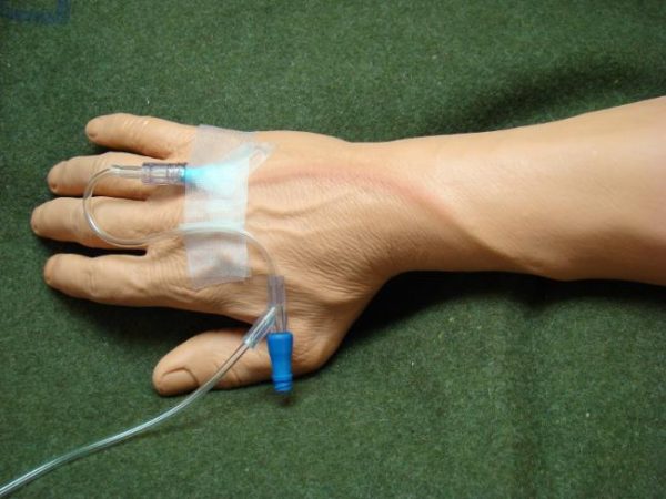 La phlébite : définition, causes et traitement - Maison et Santé